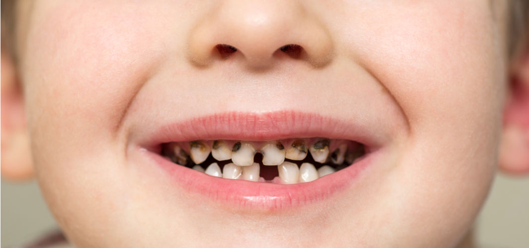 Not Brushing Your Baby’s Teeth? They Can Get Cavities Too!