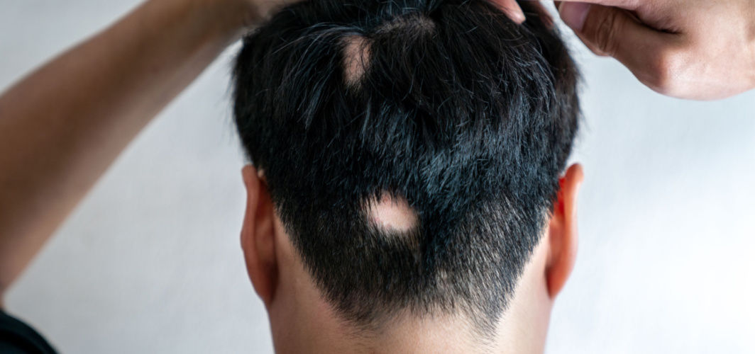 Losing Hair In Patches? It Can Be This Disease!