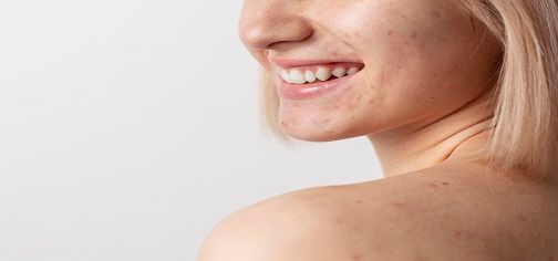 7 Tips To Manage PCOS Acne